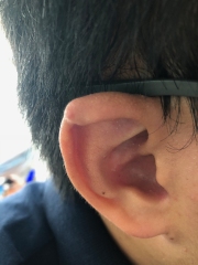 Pinna / External Ear | Dr Arasa Raj Sinnathuray
